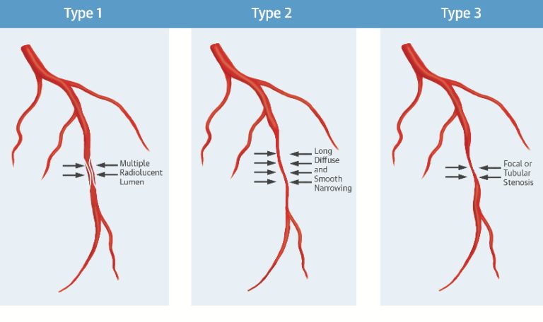 Vancouver SCAD Conference 2025 – Spontaneous Coronary Artery Dissection ...